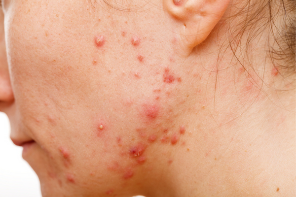 Red Light Therapy for Post Inflammatory Hyperpigmentation