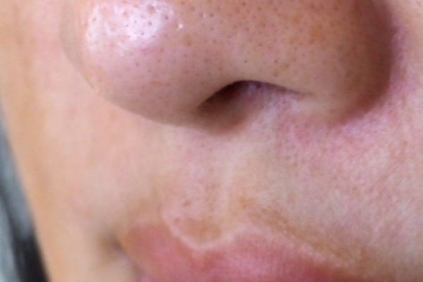How to Get Rid of Pigmentation Around the Mouth: 5 Ways