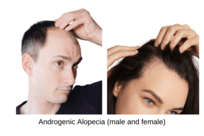 Hair Loss Treatments: How to Find the Best for Your Pattern